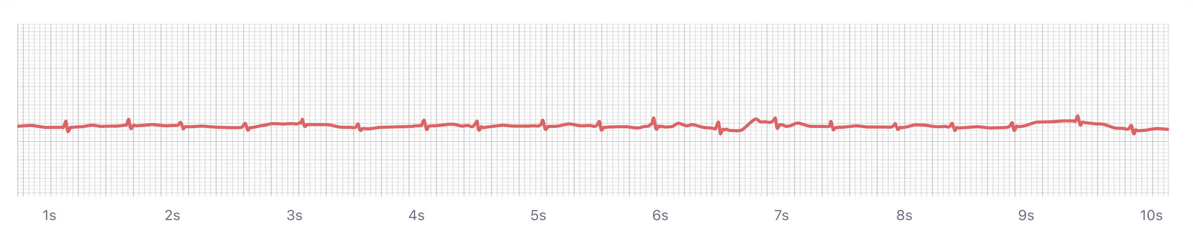 What Atrial Fibrillation (Afib) Looks Like on Your Watch ECG | Qaly